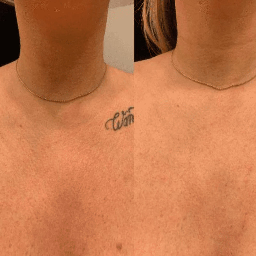 Reusable Anti Wrinkle Silicone Chest Pad Patch - Twin Pack – Nueboo